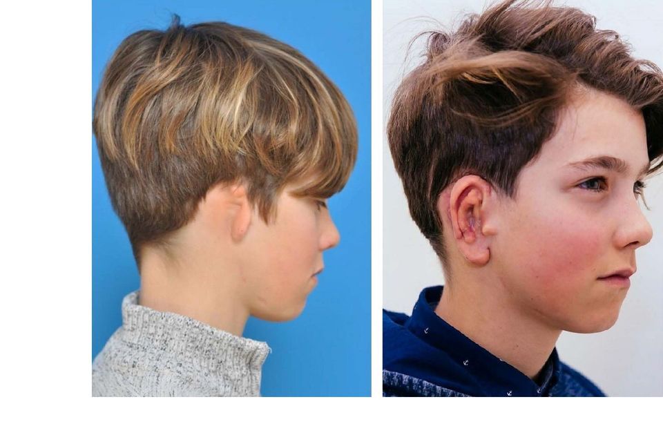 Artsen maken nieuwe oorschelp uit ribkraakbeen | UZ Leuven