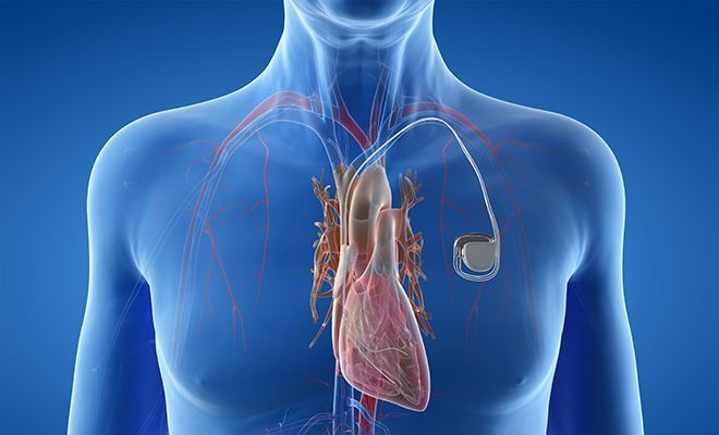 Juist of fout? De pacemaker | UZ Leuven