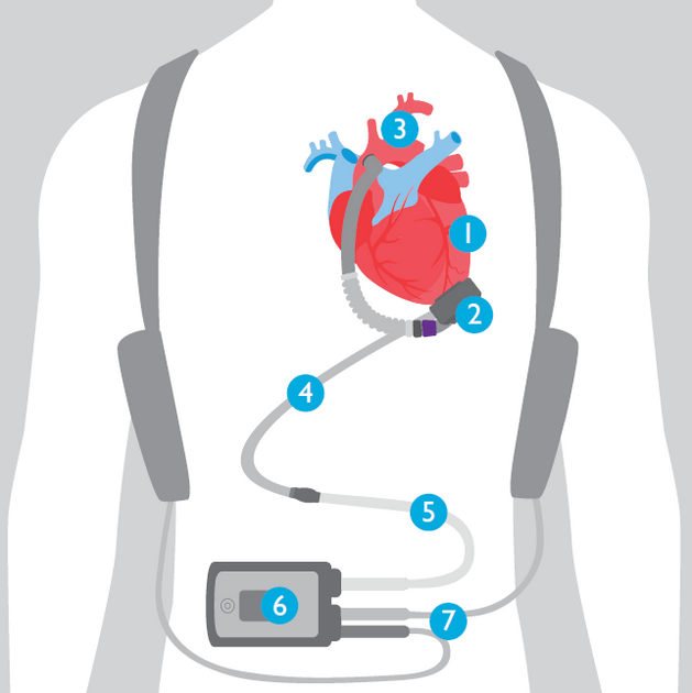LVAD (Left Ventricular Assist Device) | UZ Leuven