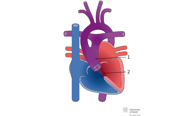 Truncus arteriosus | UZ Leuven